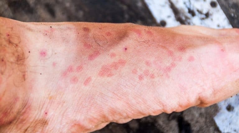 Bed Bugs Vs Scabies Bites What s The Difference 