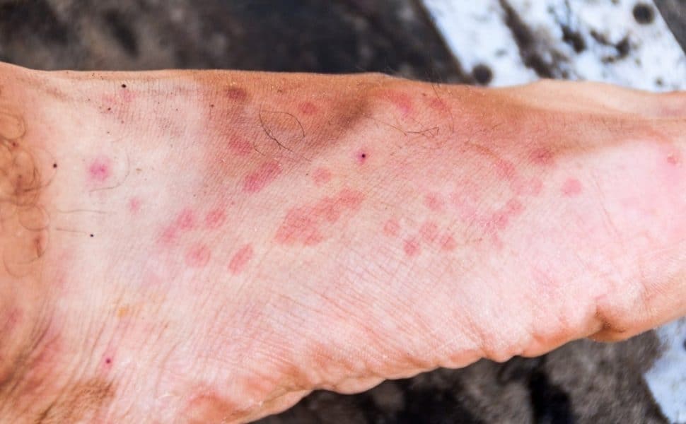 Bed Bugs vs. Scabies Bites: What's The Difference? Bed Bugs vs. Scabies Bites: What's The Difference?
