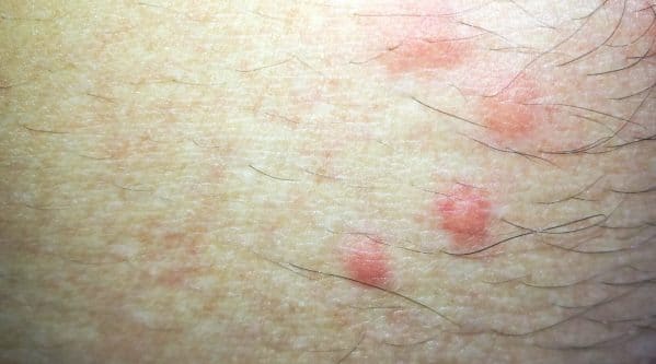 Can Humans Get Fleas? Yes! And Here's How To Repel Them!
