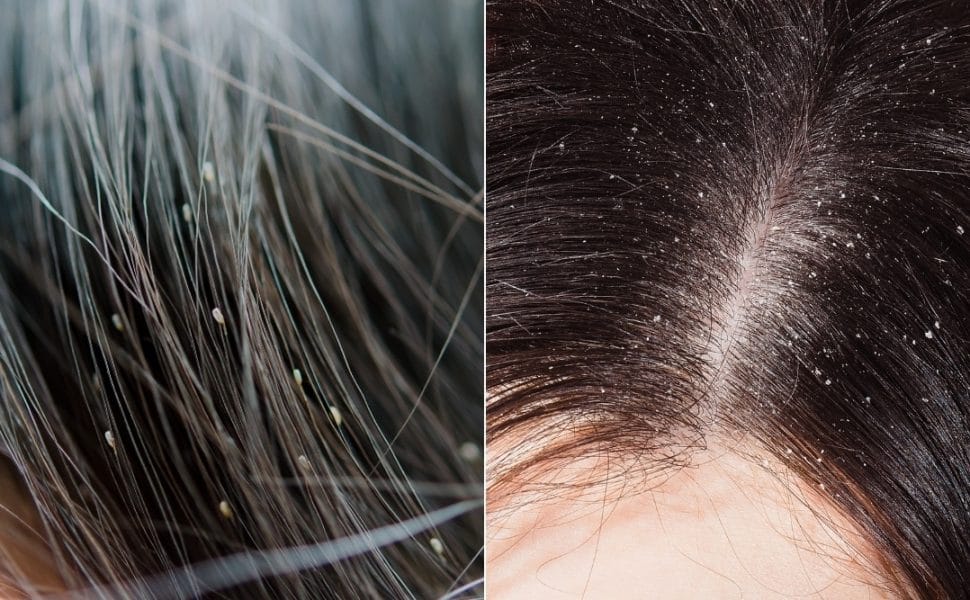Head Lice vs. Dandruff: Identifying What You Have Head Lice vs. Dandruff: Identifying What You Have