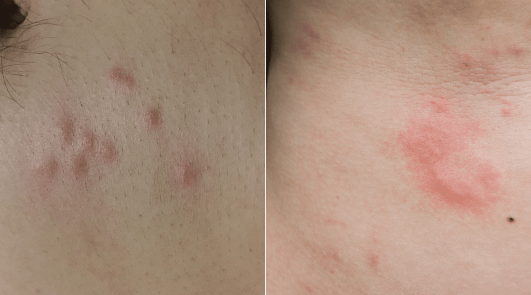 Bed Bugs vs. Hives: How to Tell If It’s Just a Bite or an Allergic Reaction